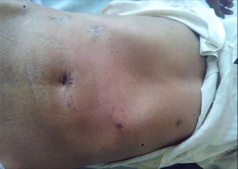Post Operative Photograph Showing Port Position For Laparoscopic Peptic