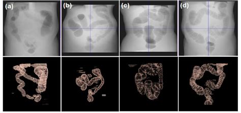 Colon Before And After Segmentation Row Drr Of The Unsegmented