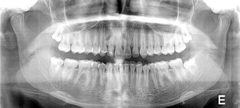 Ortopantomografia ou Radiografia Panorâmica Dental Exames RX