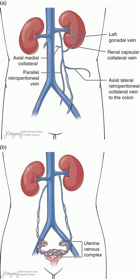 Gonadal Vein Anatomy