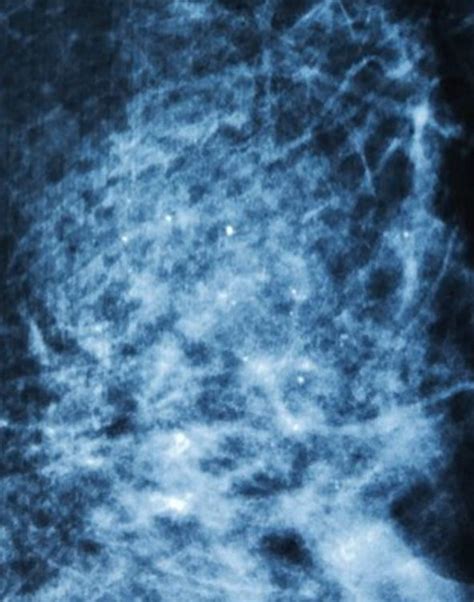 A Focal Compression View Showing A Regional Group Of Punctate