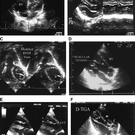 Aef Modified Echocardiographic Appearance Of Lv False Tendons In