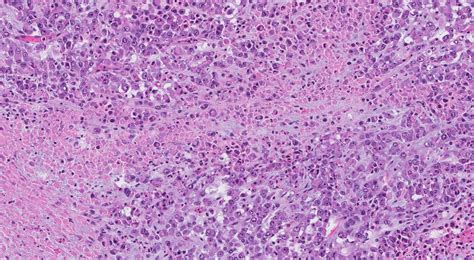 Epithelioid Sarcoma Ottawa Atlas Of Pathology
