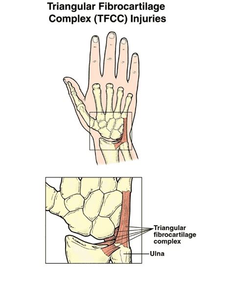 Triangular Fibrocartilage Complex Tear Hand2shoulder Clinic