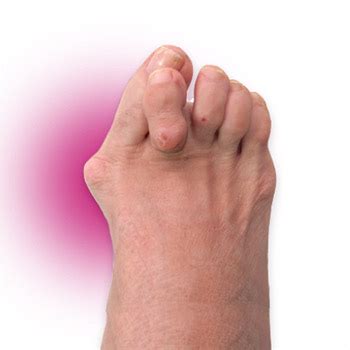 Bunion Surgery Results Gallery Before After Photos Be Bunion Free