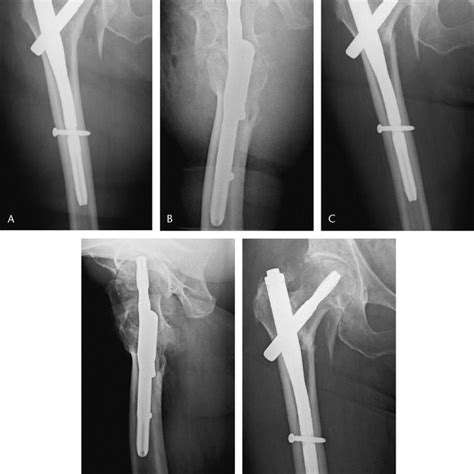 Case 2 Postoperative Radiograph With The Short Pfna Nail Ap A And