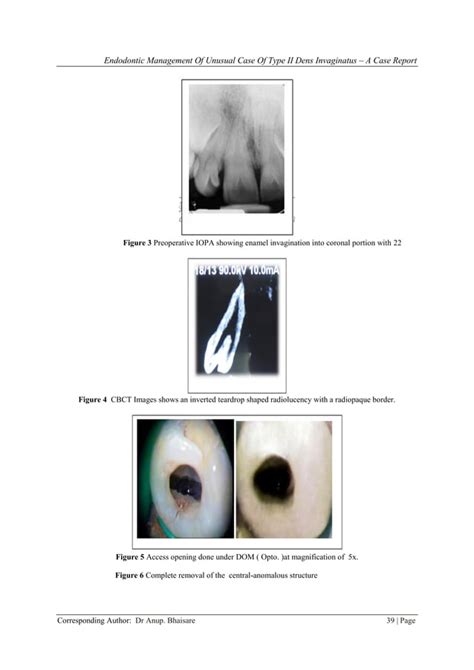 Endodontic Management Of Unusual Case Of Type Ii Dens Invaginatus A