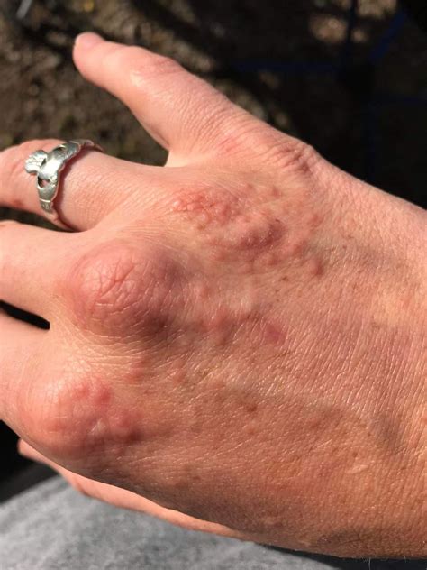 Red Bumps On Back Of Hands And Feet Rdermatology