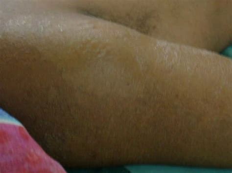 A Case Of Pyomyositis Ppt