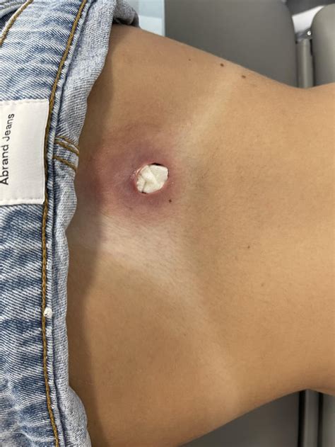 Abscess Wound Rmedicalgore