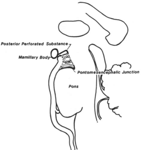 Fossa Interpeduncularis Ars Neurochirurgica