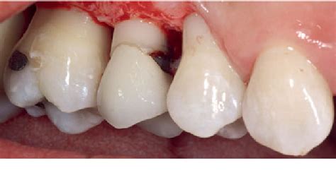 Figure 1 From Deep Margin Elevation Versus Crown Lengthening Biologic