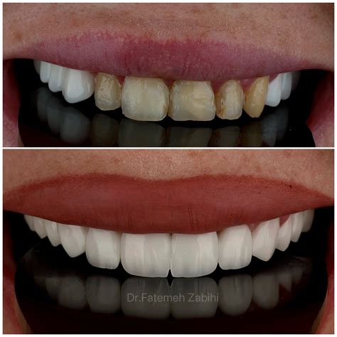 ‎دکتر فاطمه ذبیحی دندانپزشک🦷‎ Drfatemehzabihi • Instagram Photos And Videos