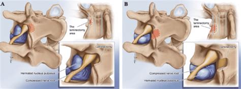 Surgical Treatment Of Far Lateral Lumbar Disc Herniation Outcomes Of The Safe And Simple
