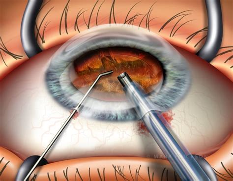 Cataract Surgery Phacoemulsification Eye Surgery Art