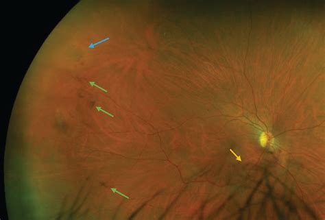 Vitreous Opacities Benign Or Serious