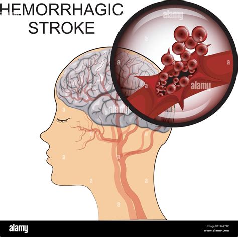 Illustration Of A Rupture Of The Vessel Hemorrhagic Stroke Insult