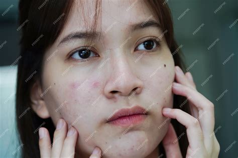 여드름 여드름 흉터 피지선의 얼굴 장애 십대 소녀 스킨 케어 미용 문제 프리미엄 사진