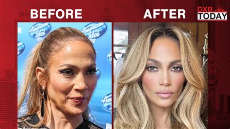 Jennifer Lopezs Plastic Surgery Expert Insights From A Plastic
