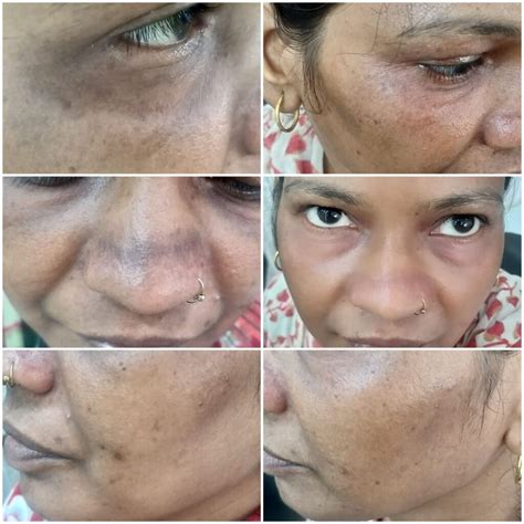 Pigmentation Intra Face Clinic