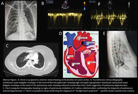 An Unusual Case Of Pulmonary Hypertension Journal Of The American