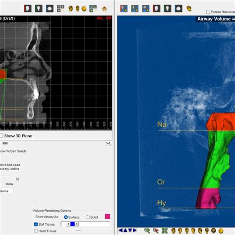 A 3d Model Of The Upper Airway Was Reconstructed And Divided Into Three