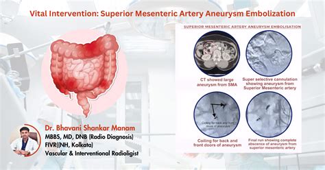 Mesenteric Aneurysm Embolization