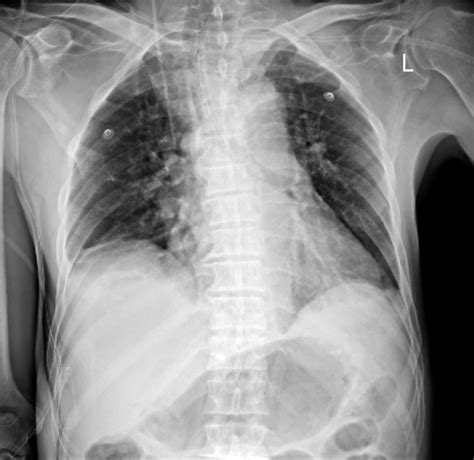 Simultaneous Occurrence Of Perforated Peptic Ulcer And Acute