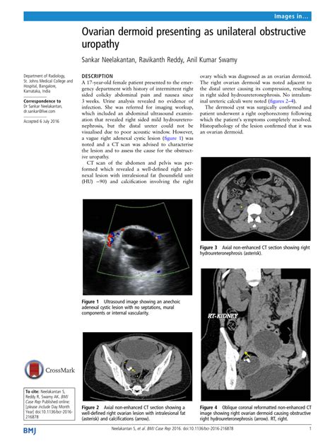 Pdf Ovarian Dermoid Presenting As Unilateral Obstructive Uropathy