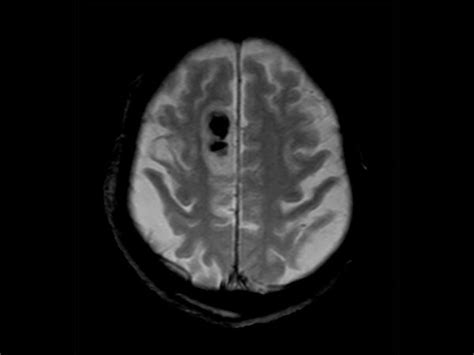 Brain Acute Stroke Philips Mr Body Map