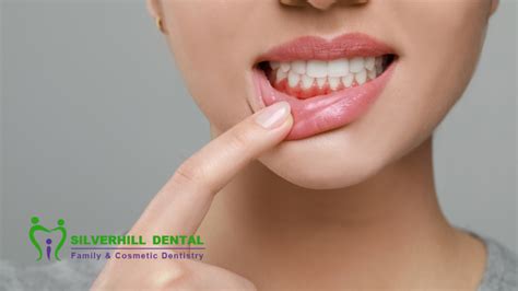 Black Gums And Spots On Gums Causes Treatment And Reasons