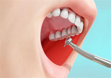 Premium Photo Human Tooth Caries Removal Process With Drill Machine