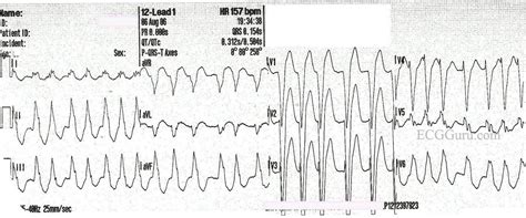 Teaching Series Atrial Fibrillation With Left Bundle Branch Block