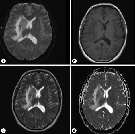 A D Right Basal Ganglia Showing Previous T2flair Hyperintensity Along