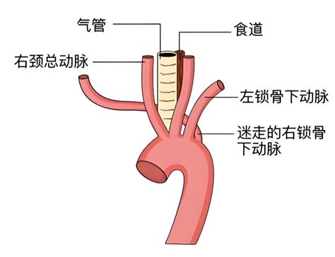 迷路的锁骨下动脉 知乎