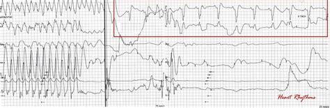 Pulseless Electrical Activity Rhythm Strip