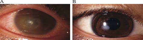Characteristics Of Pseudomonas Corneal Infection Related To Cornea