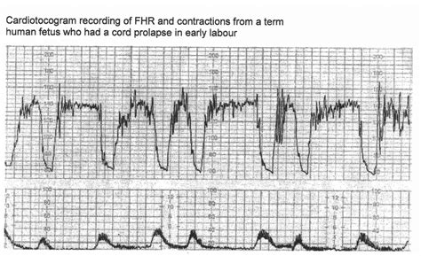 Ctg In A Case Of Cord Prolapse Showing Late Decelerations Reproduced
