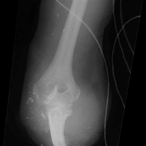 Intraoperative Photograph Of A Limb With A Transradial Amputation As