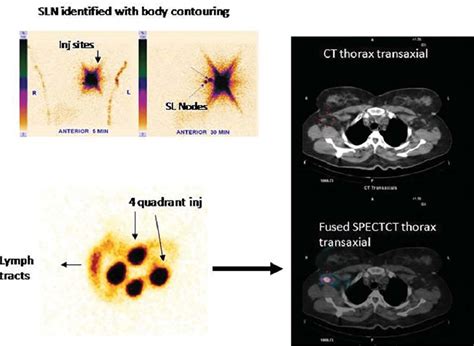 Demonstrates Sentinel Node Imaging Static And Spectct Images