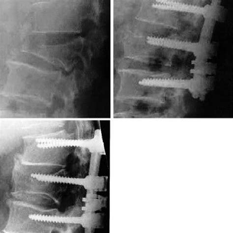 The Load Shearing Classification Of Spine Fractures Download Table