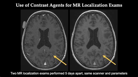 Gadopiclenol Use In Stereotactic Localization Radiosurgery Procedures Applied Radiology