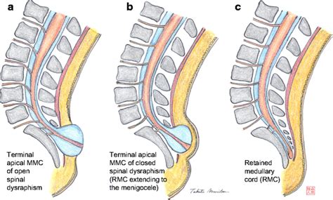 A Schematic Drawing Of A Terminal Apical Placode Of A Myelomeningocele