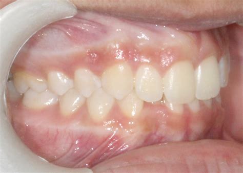 Case Gallery Clearcorrect