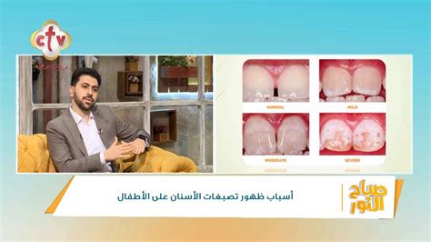 أسباب تغير لون الأسنان وظهور تصبغات صفراء عند الأطفال برنامج صباح