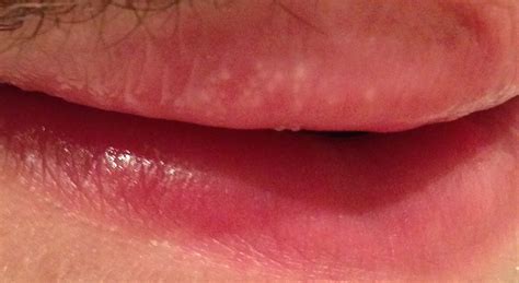 Small White Bumps On Upper Lip Raskdocs