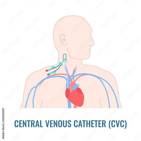 Photo And Art Print Central Venous Catheter Placed In The Jugular Vein