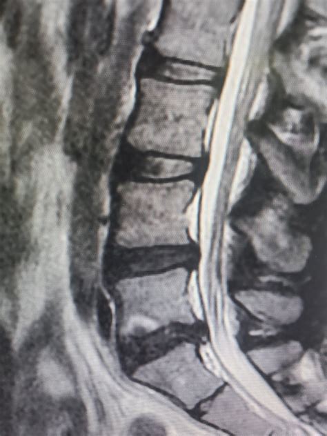 Is Fusion The Only Option At This Point R Spinalfusion