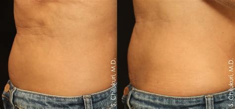 Btl Emsculpt Neo Abdomen 2 Refresh Dermatology