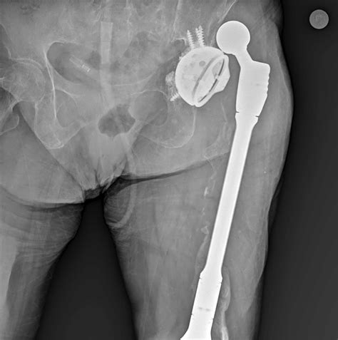 Antero Posterior View Of The Pelvis Showing Dislocation Of The Left Hip